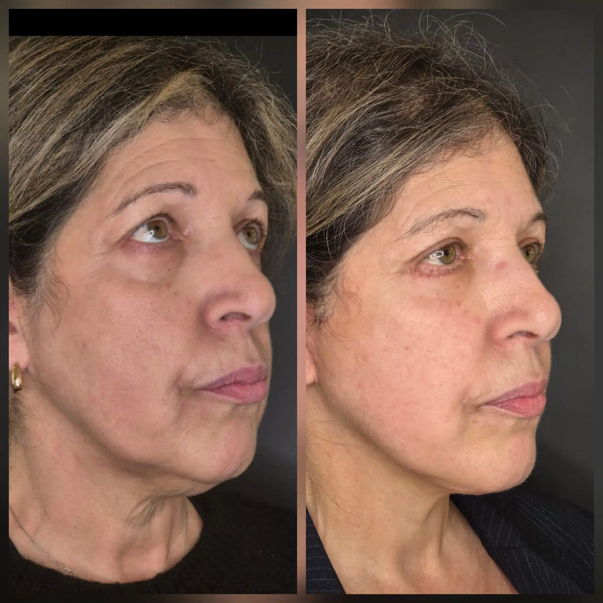 SMAS Lifting : rajeunissez votre visage en profondeur